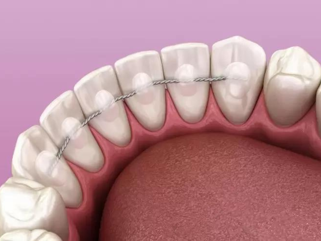 รู้หรือไม่ ! รีเทนเนอร์ (Retainer) มีกี่แบบ เเต่ละแบบผลลัพธ์ต่างกัน ...