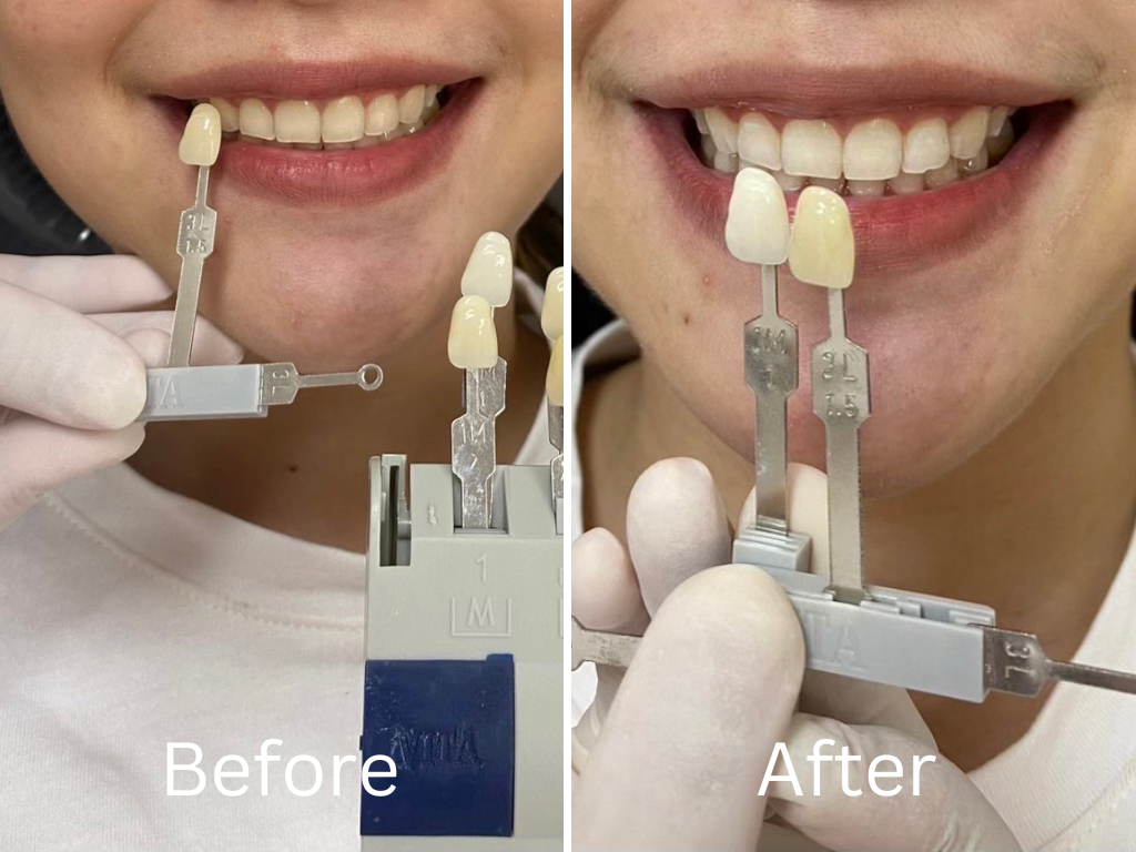 ฟอกสีฟัน Tooth Place Dental Clinic ด้วยระบบ Cool Light ในราคาสุดคุ้ม