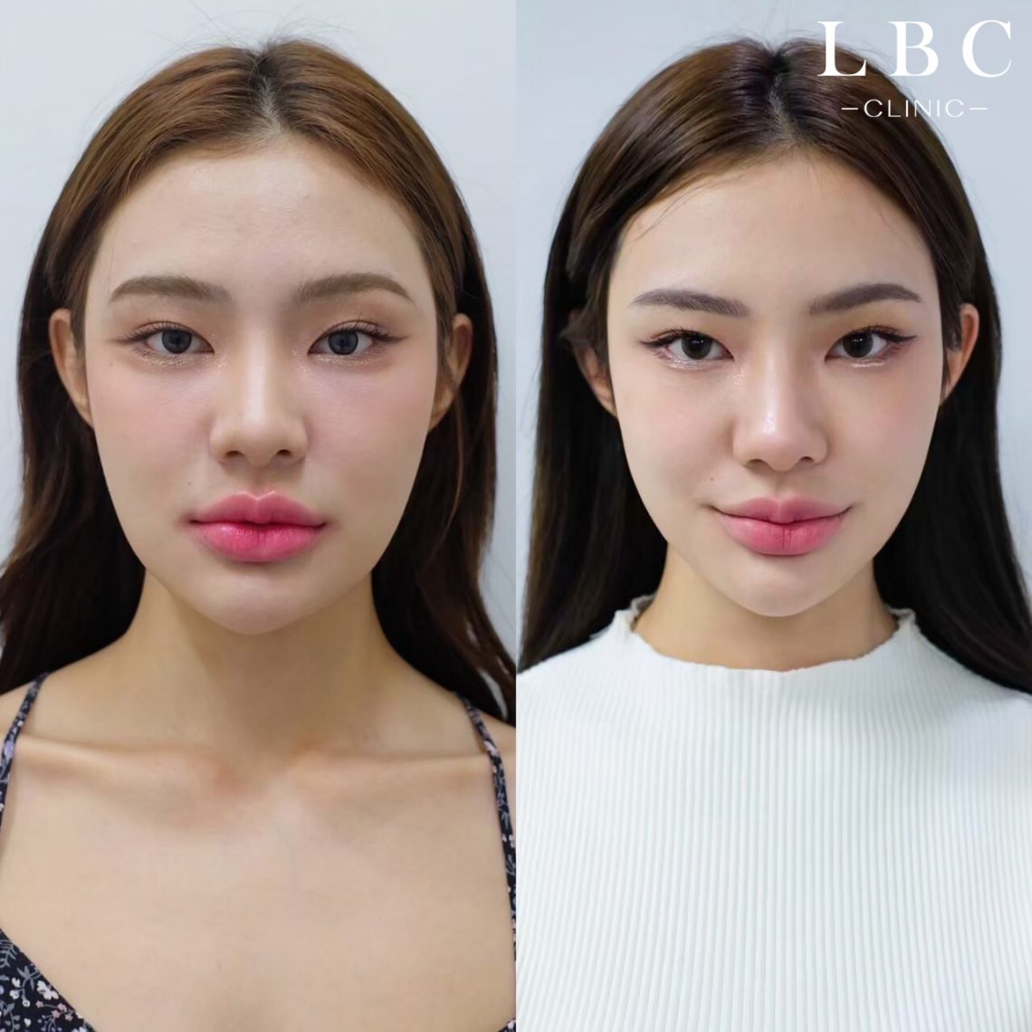 ทำความรู้จักโบเกาหลียอดฮิต Nabota botox ดียังไง ทำไมต้องนาโบตะ