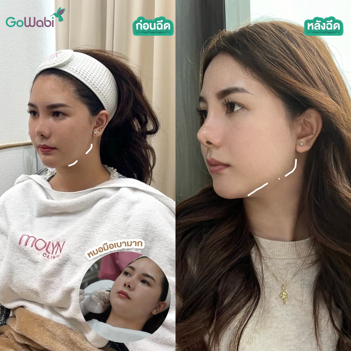 Molyn Clinic รีวิวฉีดโบท็อกซ์กราม หน้าเรียวแถมได้คอนเทนต์
